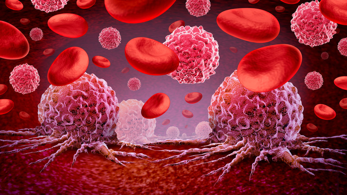 CD16 als prognostischer Marker bei aggressivem B-NHL/DLBCL