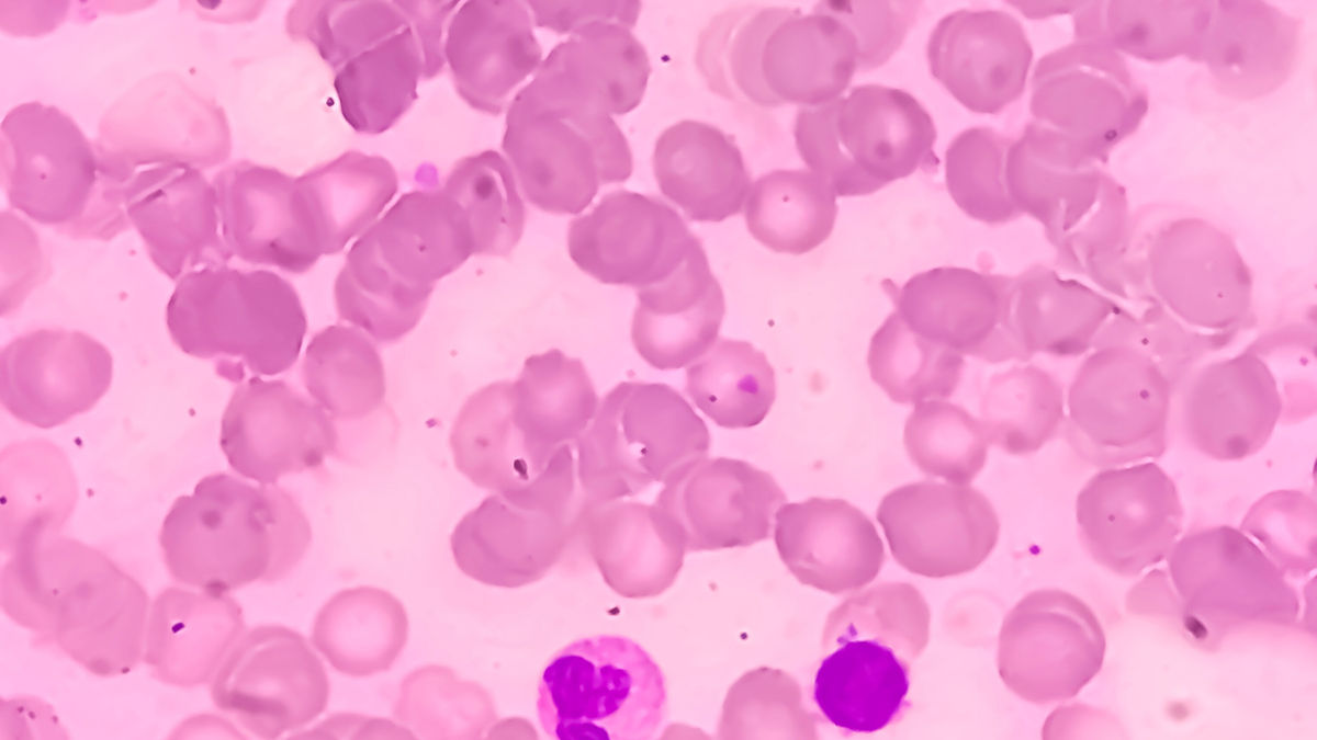 Venetoclax beim MDS – wie geht es jetzt weiter?